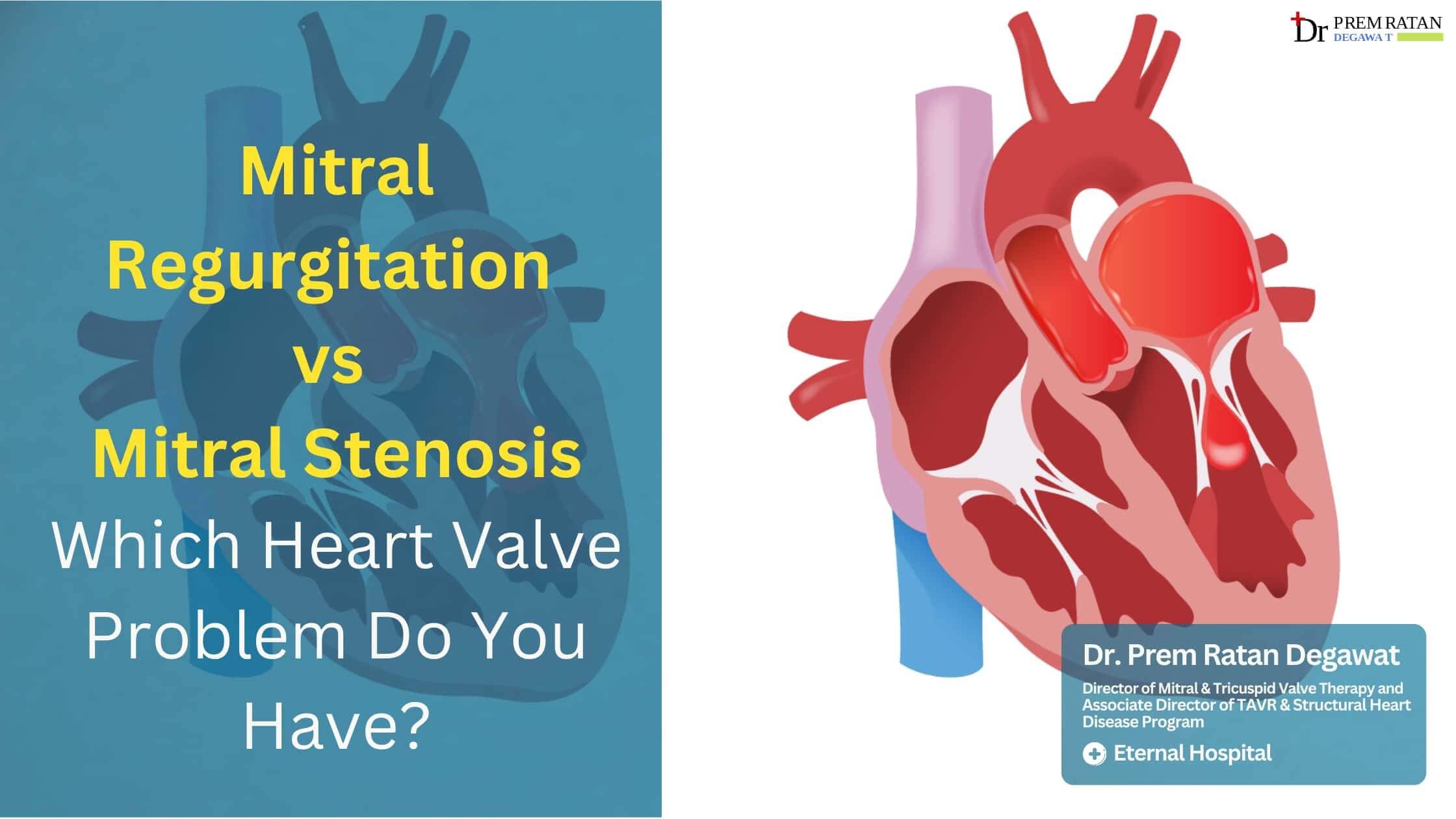 Mitral Regurgitation vs Stenosis: Symptoms, Treatment & Diagnosis | Jaipur